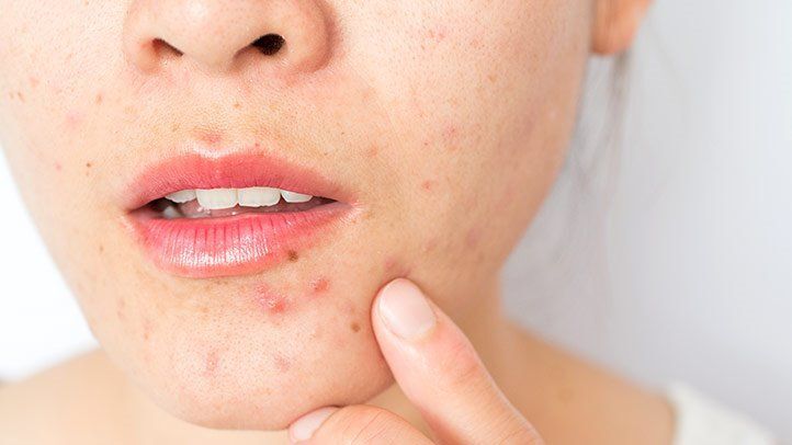 Saliva for Acne? Does Saliva Really Work? - Beauty Tips By Nim